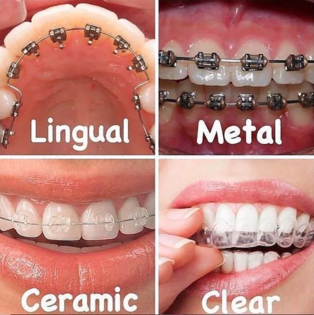 5 Types of Braces for Teeth – Metal, Ceramic, Self Ligating, Lingual ...